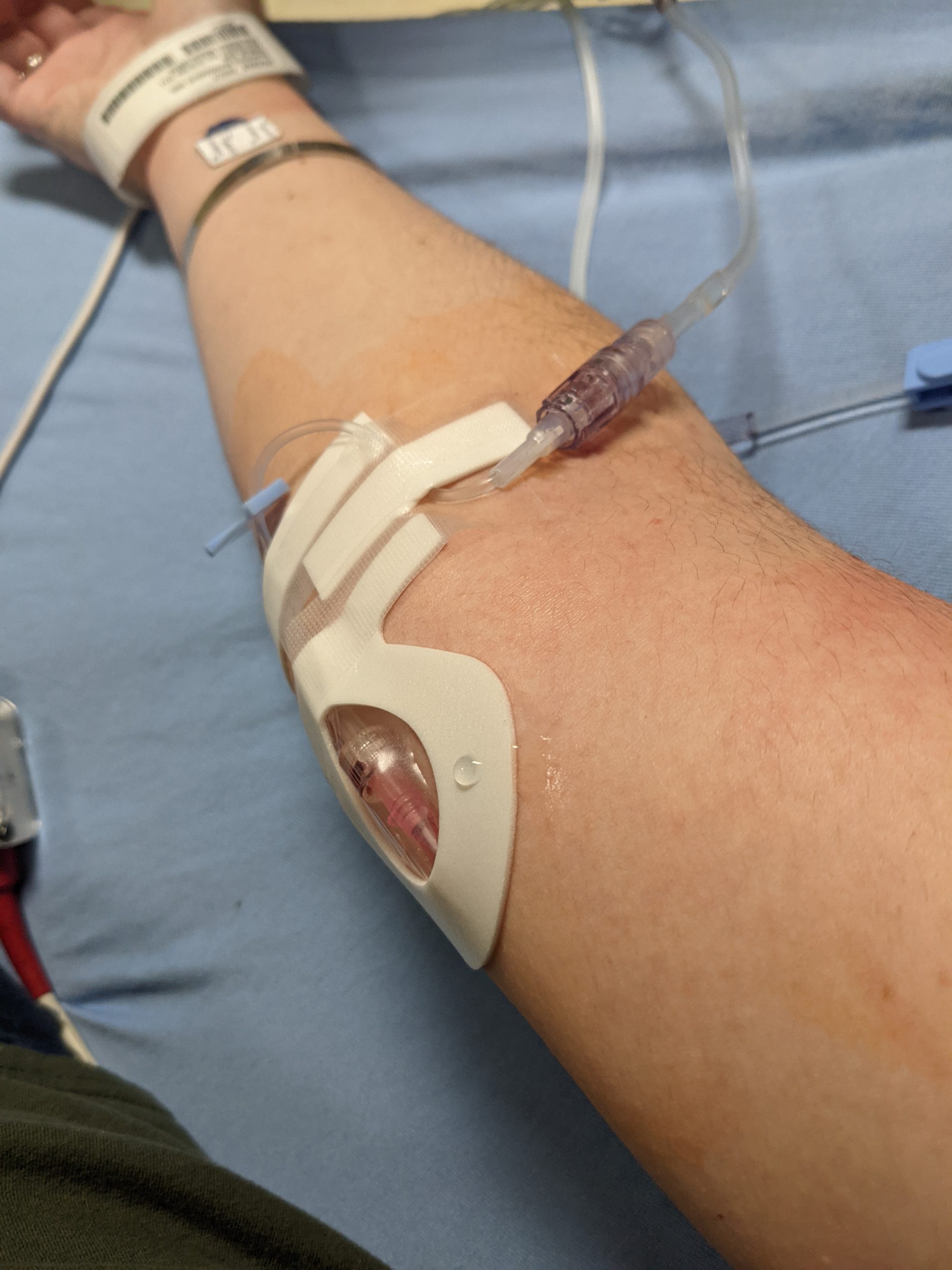 How I got my Port-A-Cath ⋆ Clearly Alive